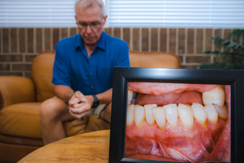 Full Mouth Reconstruction in Cape Coral | Dental Restoration