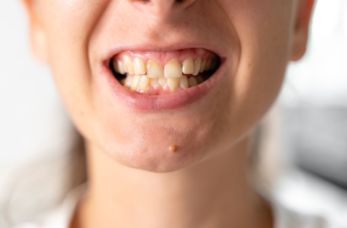 How to Get Rid of White Spots on Teeth: Causes and Solutions